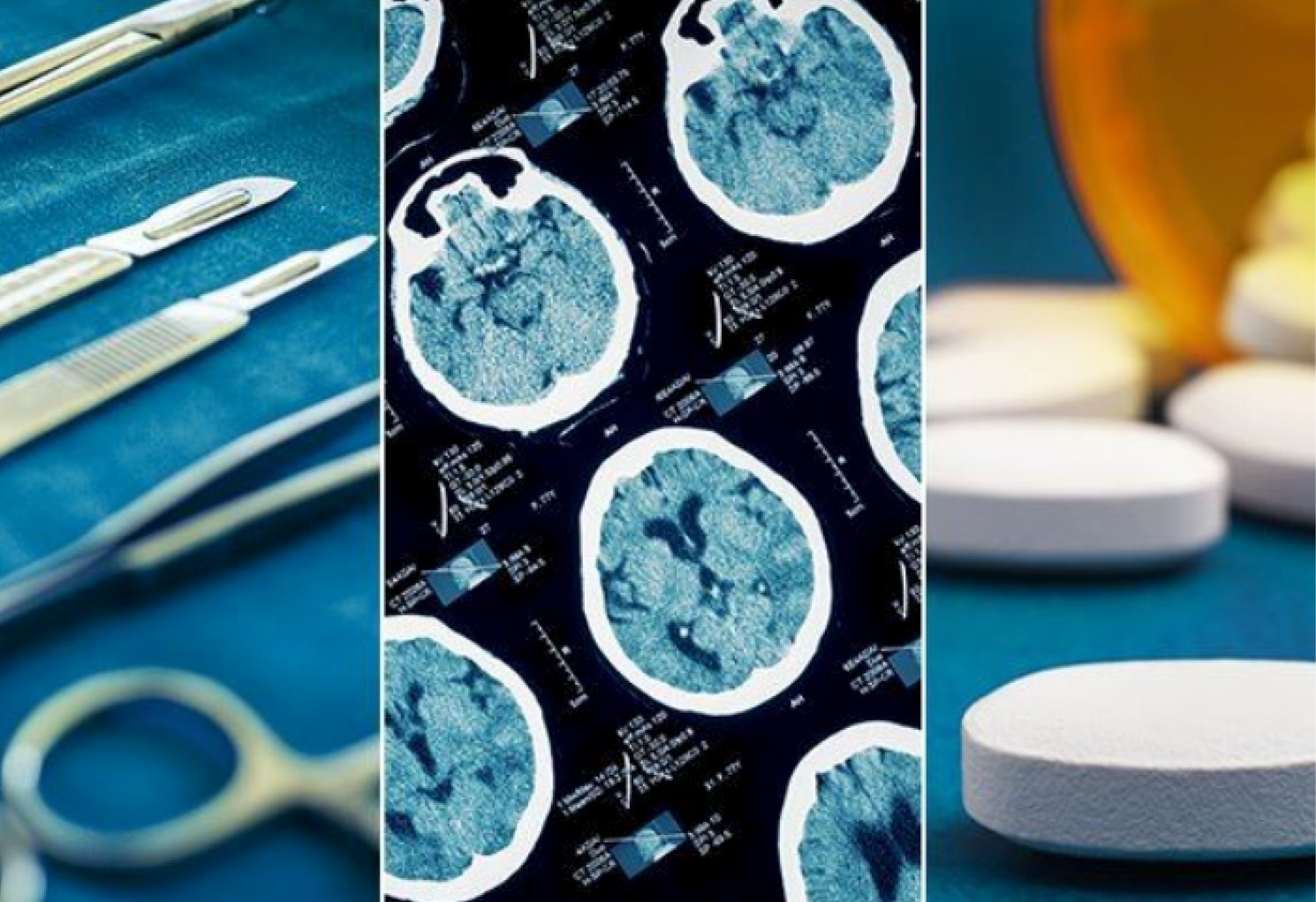 Are Brain Aneurysms Treatable and Beatable? - Brain Aneurysm Foundation