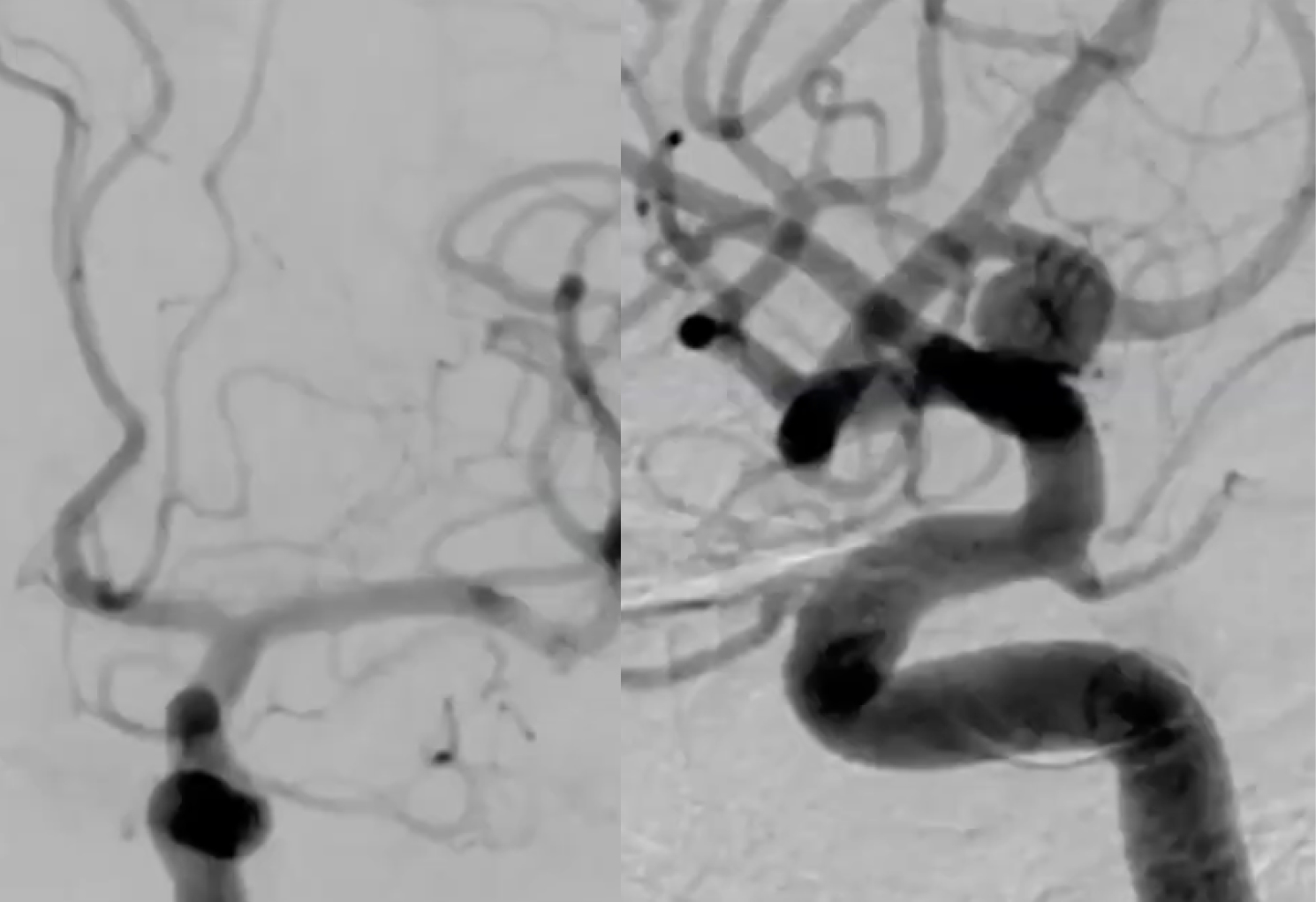 The Role Of Ai In Aneurysm Detection And Tracking Brain Aneurysm Foundation