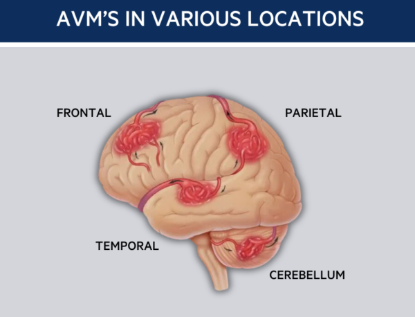 Arteriovenous Malformations - Brain Aneurysm Foundation