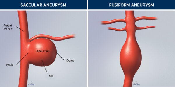About Brain Aneurysms - Brain Aneurysm Foundation