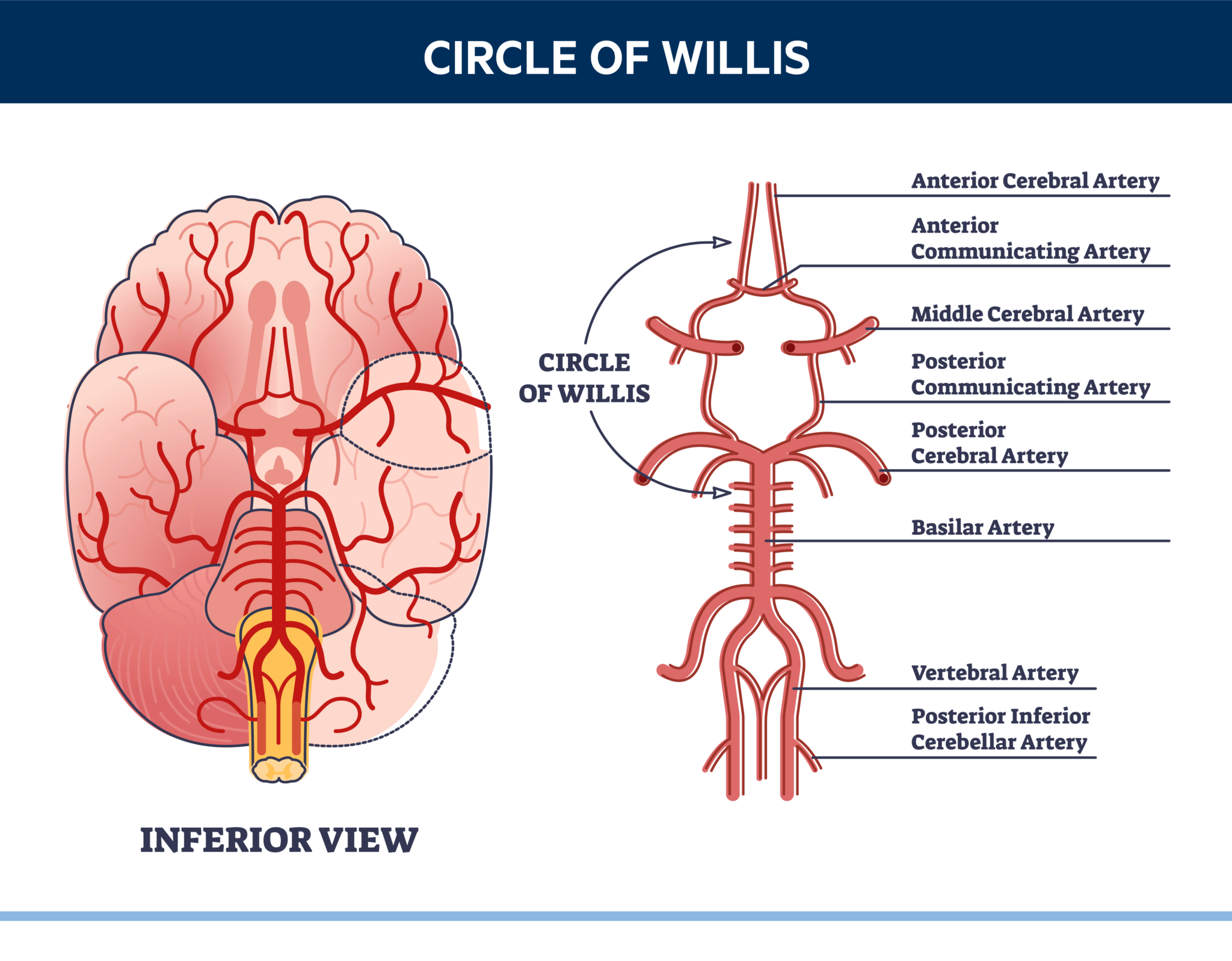 About Brain Aneurysms - Brain Aneurysm Foundation