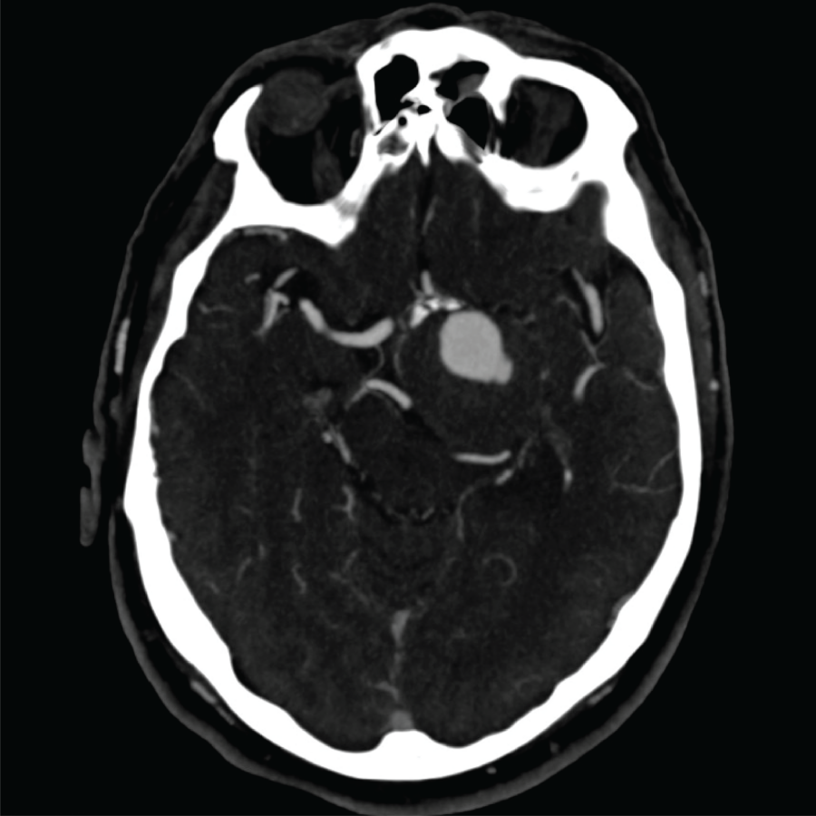 Navigating Imaging Options for Brain Aneurysms - Brain Aneurysm Foundation