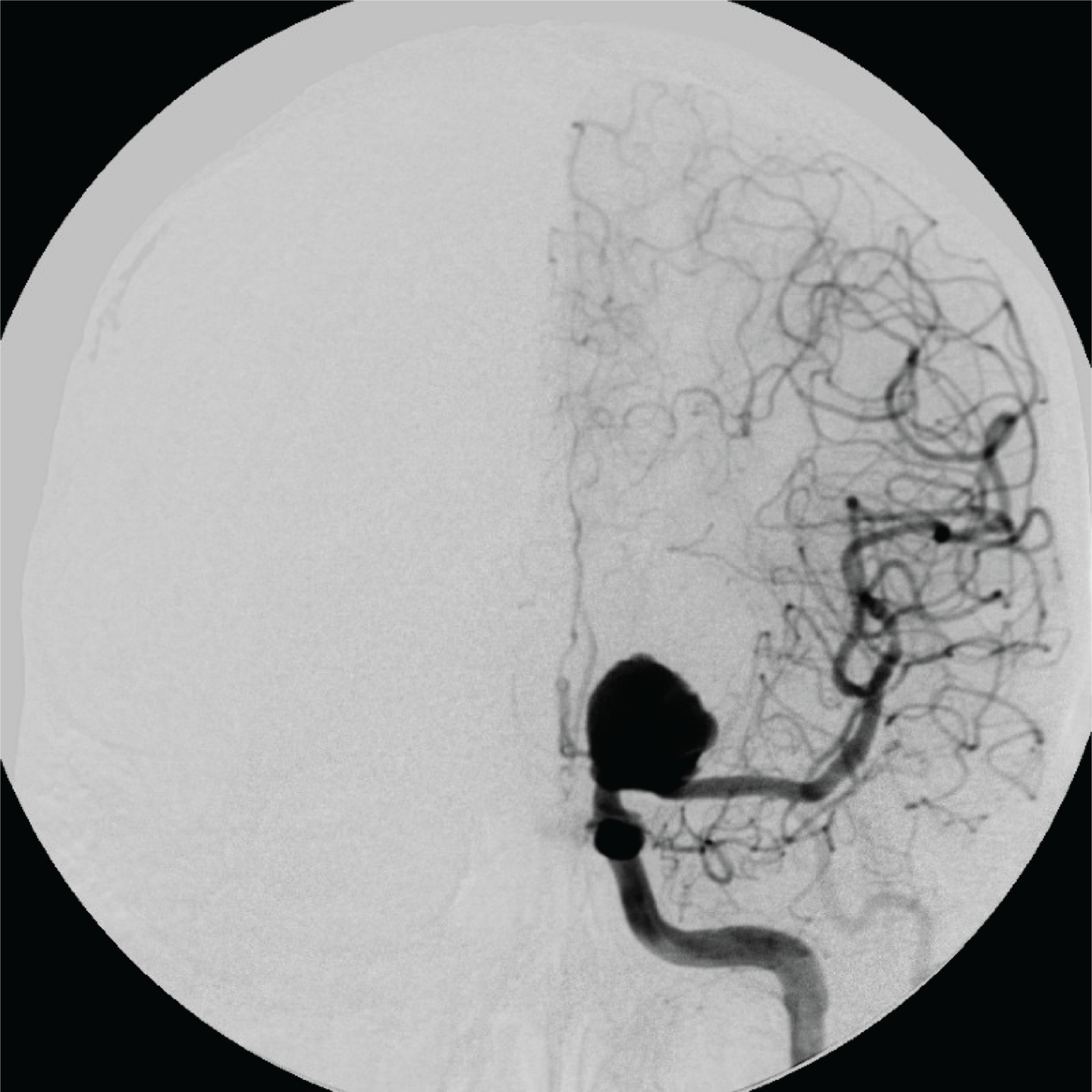 Navigating Imaging Options for Brain Aneurysms - Brain Aneurysm Foundation