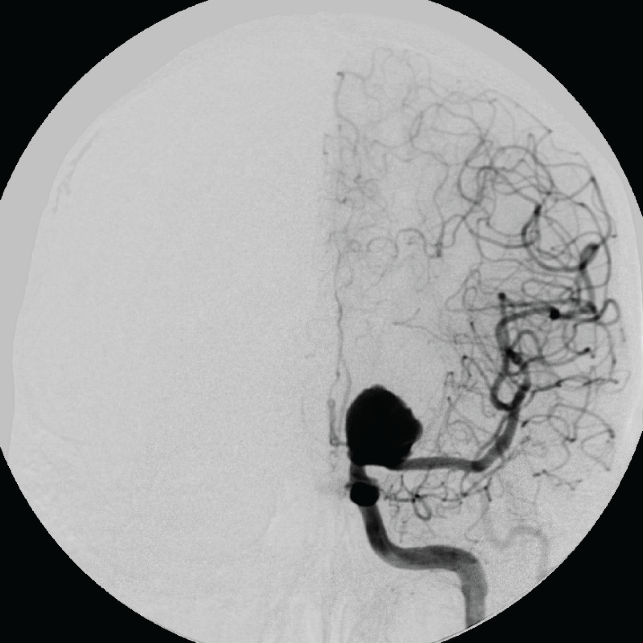 Navigating Imaging Options for Brain Aneurysms - Brain Aneurysm Foundation
