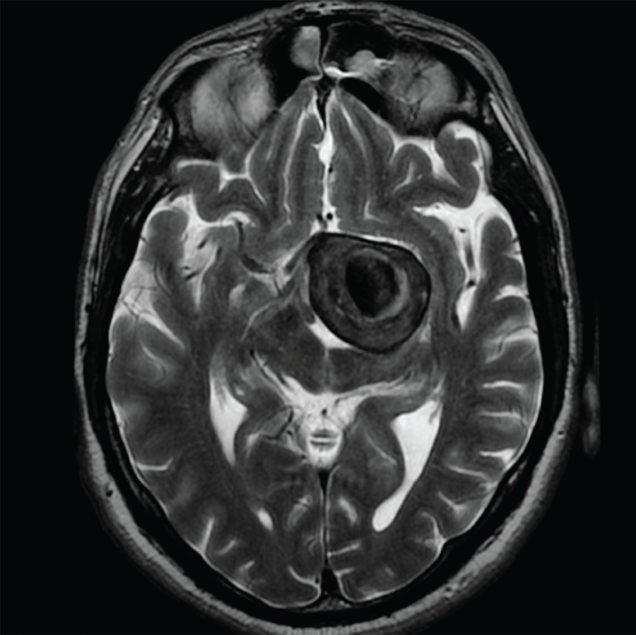 Navigating Imaging Options for Brain Aneurysms - Brain Aneurysm Foundation